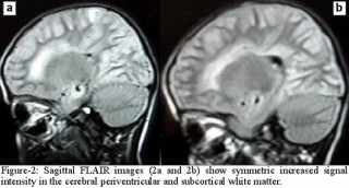 Acute Necrotising Encephalopathy (ANEC) – DoktorBudak